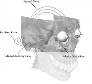 CT based Exophthalmometry | Stratovan